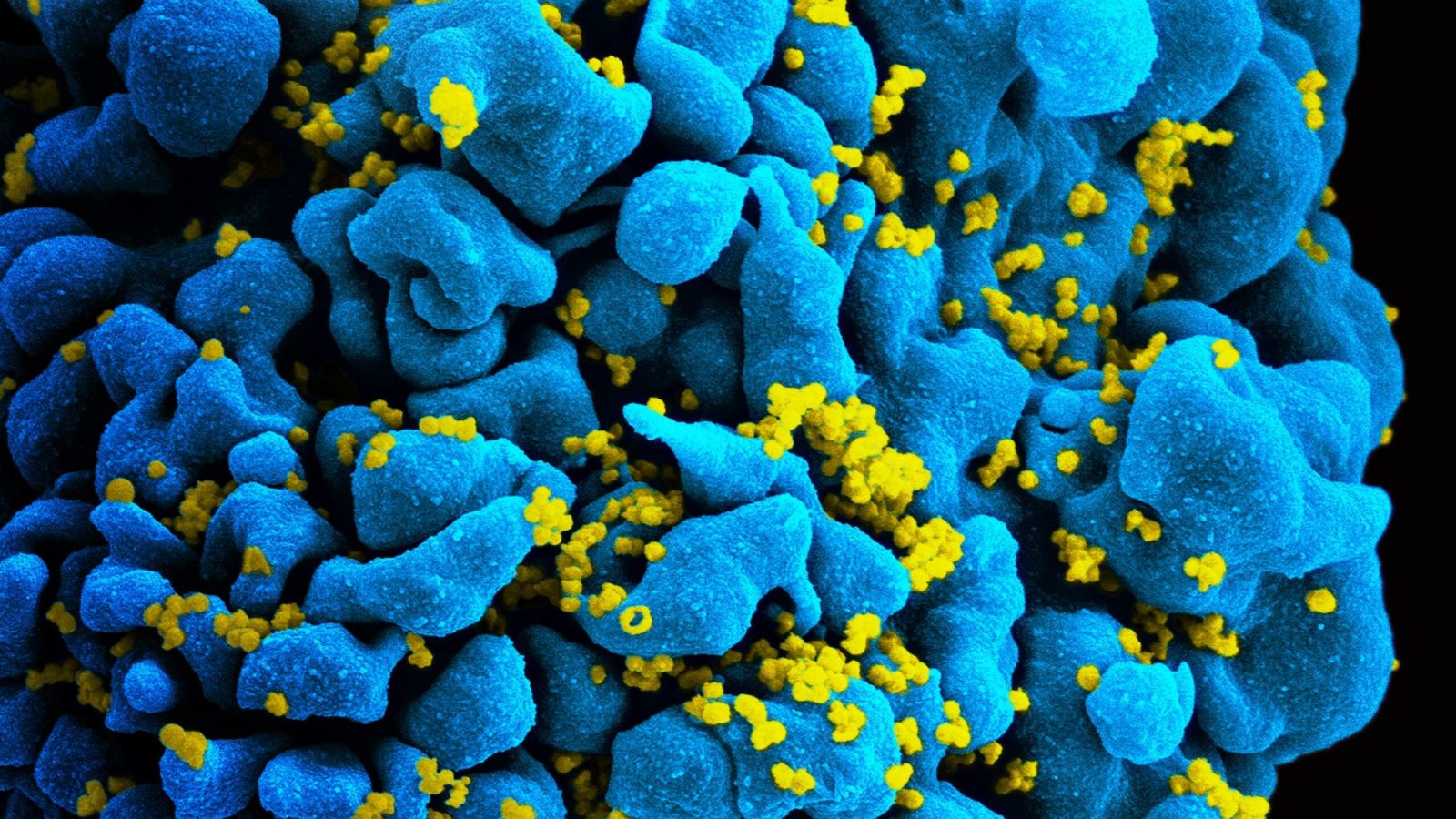 Groundbreaking new cure for HIV/AIDS found in immunotherapy