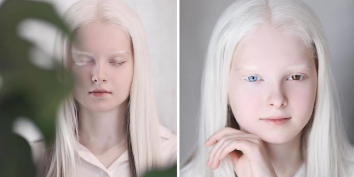 This 11 year old girl has two genetic mutations resulting in amazing beauty