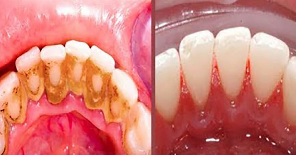 Housewife's plaque removing trick will keep you from visiting the dentist