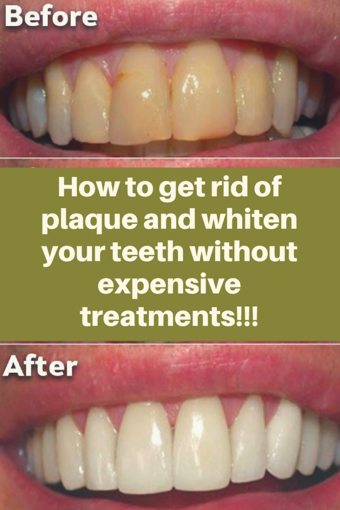 Housewife's plaque removing trick will keep you from visiting the dentist