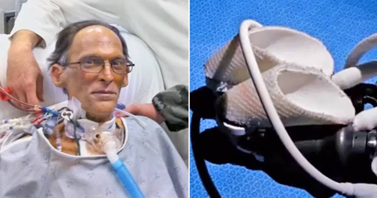 Meet The World’s First Heartless Human Able To Live Without A Pulse