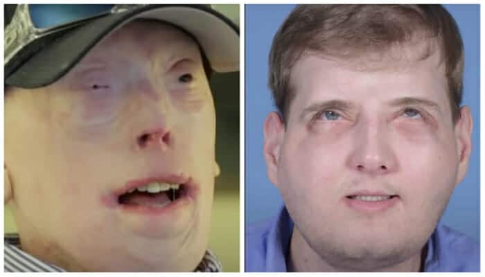 Firefighter Who Suffered Third-Degree Burns Gets a Face Transplant ...