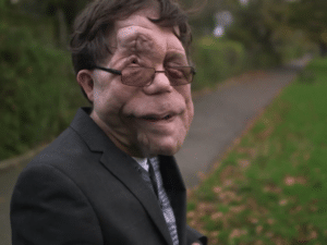 The story of Adam Pearson, who refused to spend his life suffering and ...