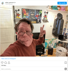 The story of Adam Pearson, who refused to spend his life suffering and ...